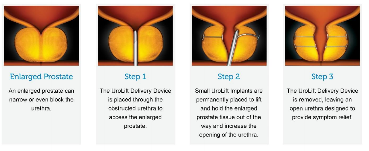 UroLift